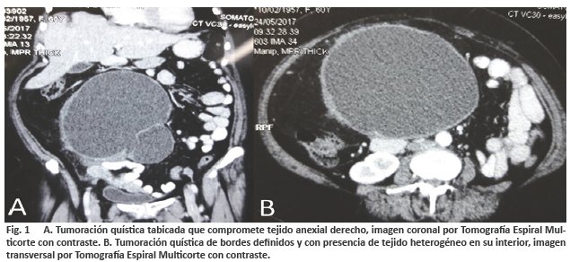 Teratoma QuÍstico Maduro De Ovario Experiencia En Un Hospital Del