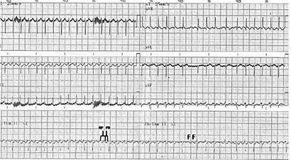 FLUTTER AURICULAR EN NEONATOLOGIA. REPORTE DE CASO.